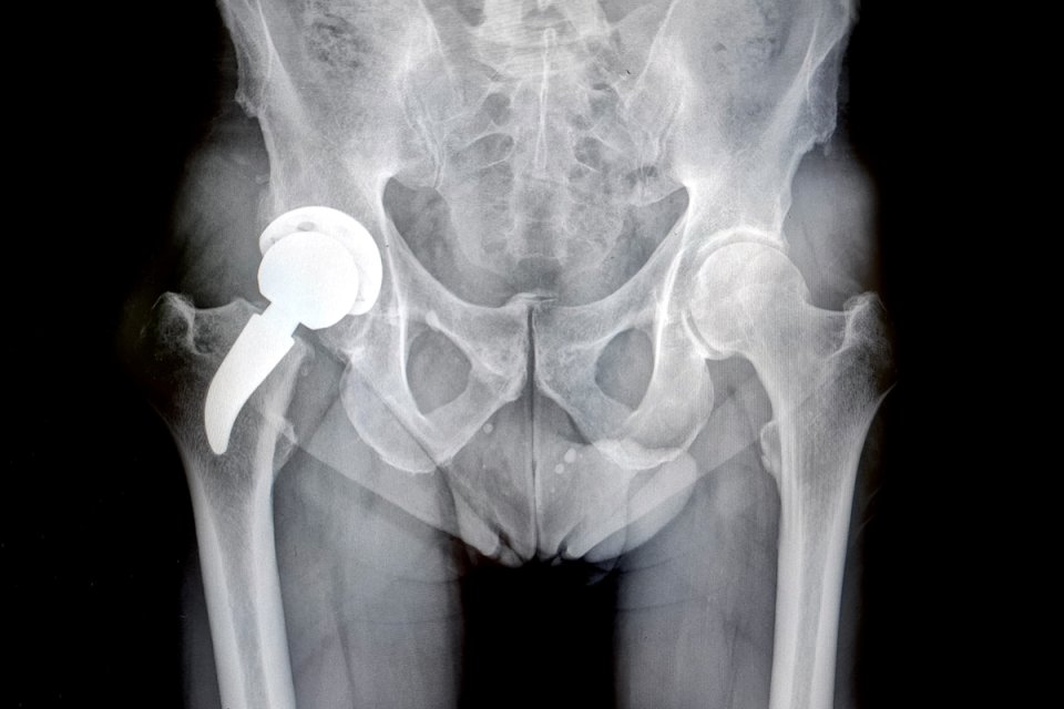 La chirurgia protesica dell’anca personalizzata