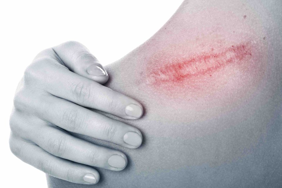 Debellare cheloidi, Terapia laser, Cicatrici ipertrofiche